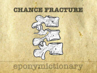 Chance fracture Archives • LITFL