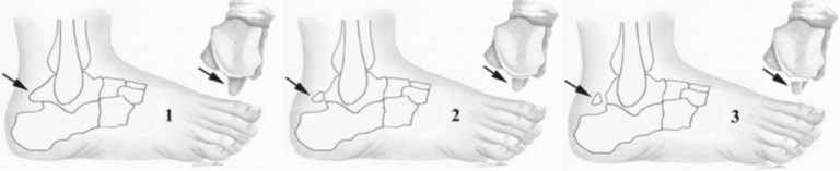 Shepherd fracture • LITFL • Medical Eponym Library