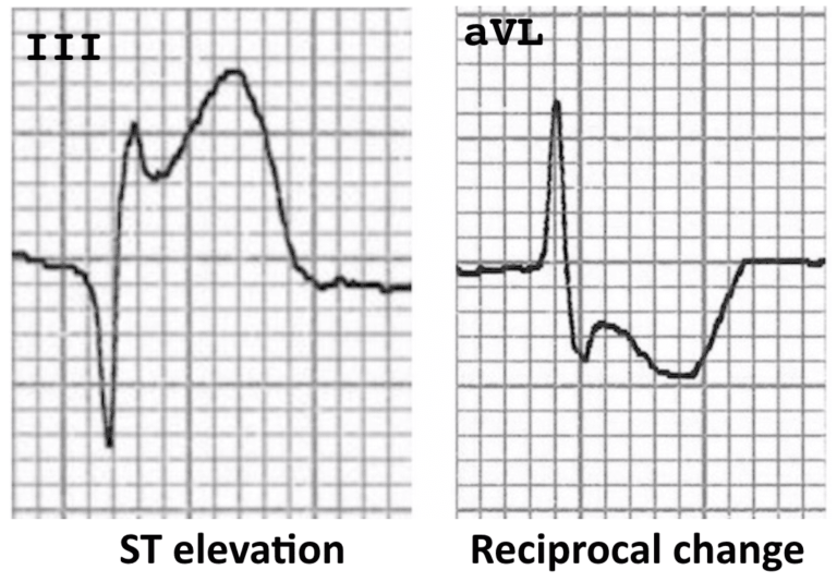 The ST Segment • LITFL • ECG Library Basics
