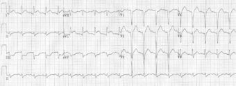 Lateral STEMI ECG changes • LITFL • ECG Library Diagnosis