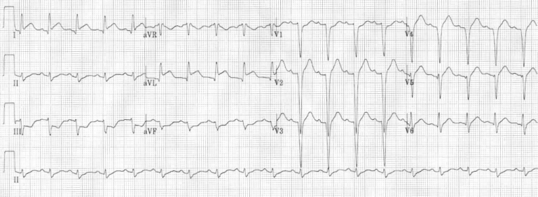 Lateral STEMI ECG changes • LITFL • ECG Library Diagnosis