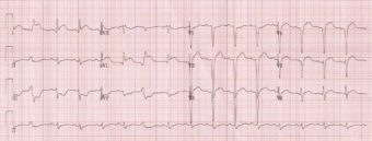 High Lateral STEMI • LITFL • ECG Library Diagnosis