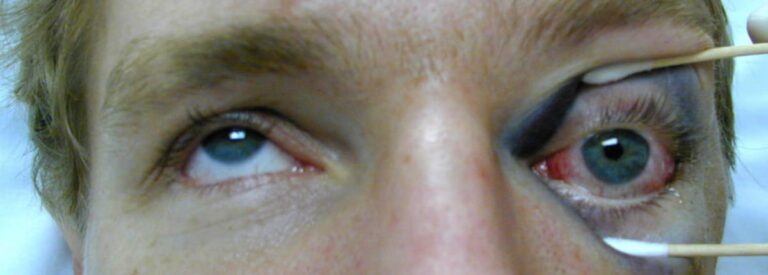 Blown out • LITFL Medical Blog • Ophthalmology Befuddler