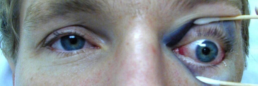 Blown out • LITFL Medical Blog • Ophthalmology Befuddler