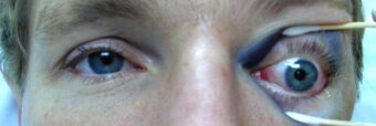 Blown out • LITFL Medical Blog • Ophthalmology Befuddler