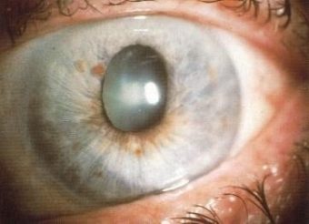 Blind, Aching and Vomiting • LITFL • Ophthalmology Befuddler