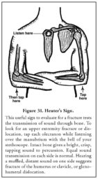Auenbrugger Bone Sign • LITFL • Medical Eponym Library