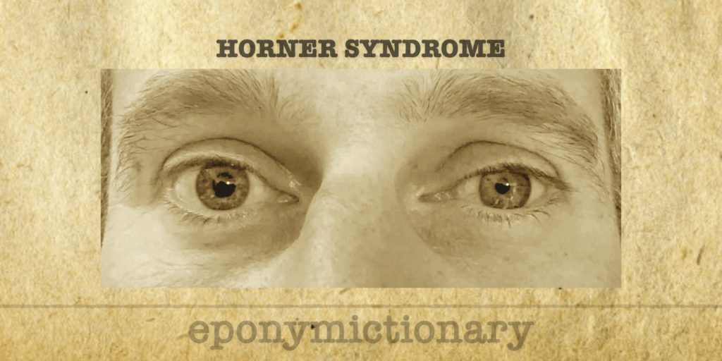 Horner Syndrome • LITFL • Medical Eponym Library