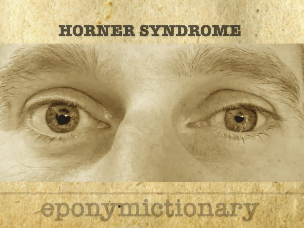 Horner's syndrome Archives • LITFL