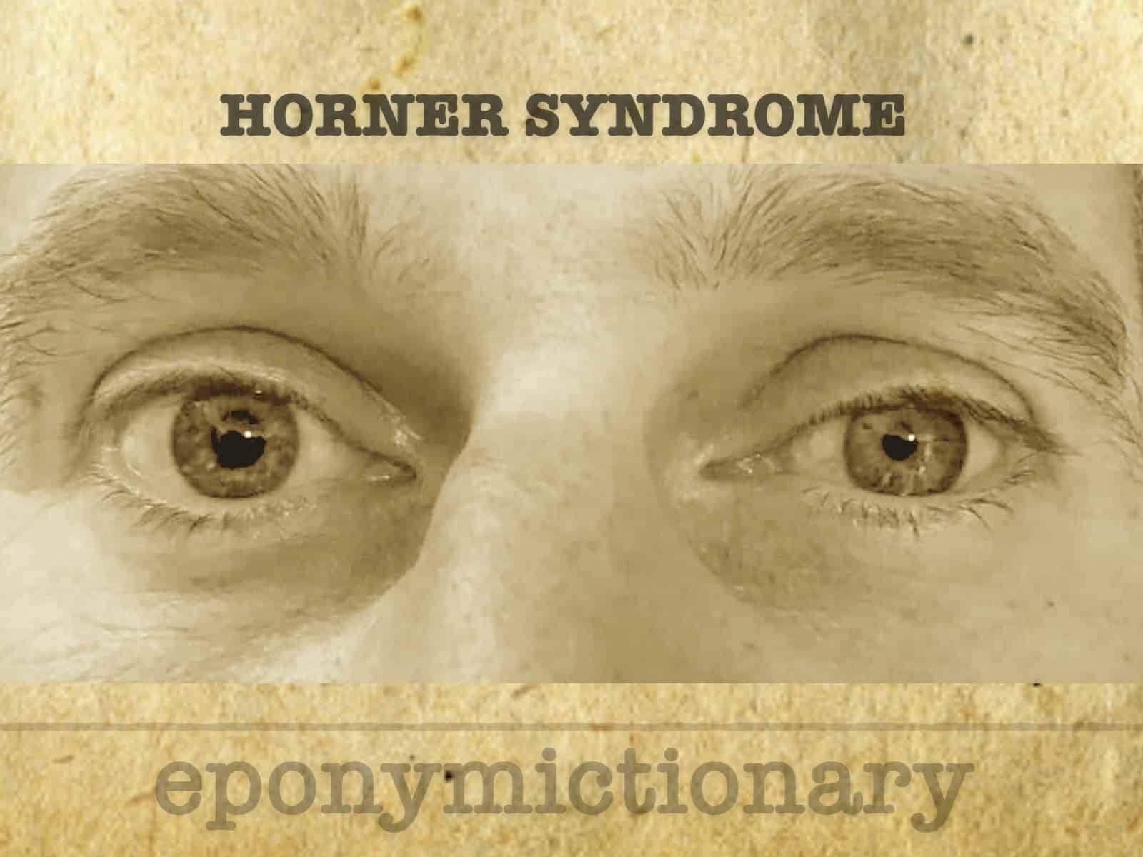 Horners Syndrome