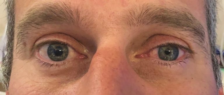 FFS: Horner Syndrome • LITFL • FFS