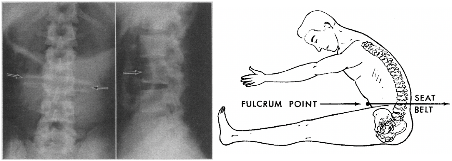 Chance fracture • LITFL Medical Blog • Medical Eponym Library