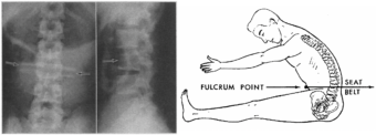 Chance fracture • LITFL Medical Blog • Medical Eponym Library