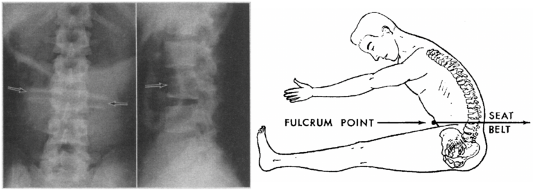 Chance fracture • LITFL Medical Blog • Medical Eponym Library