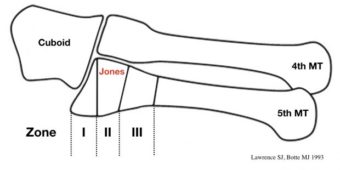 Jones Fracture • LITFL • Medical Eponym Library