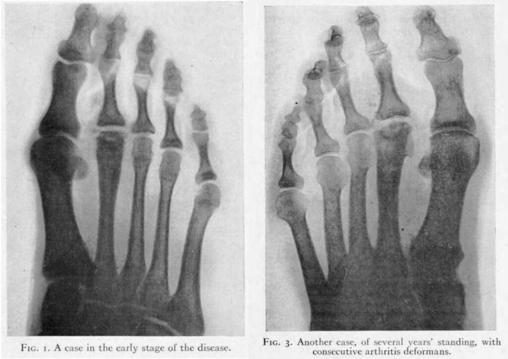 Freiberg infraction • LITFL • Medical Eponym Library