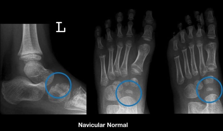 Köhler disease • LITFL • Medical Eponym Library
