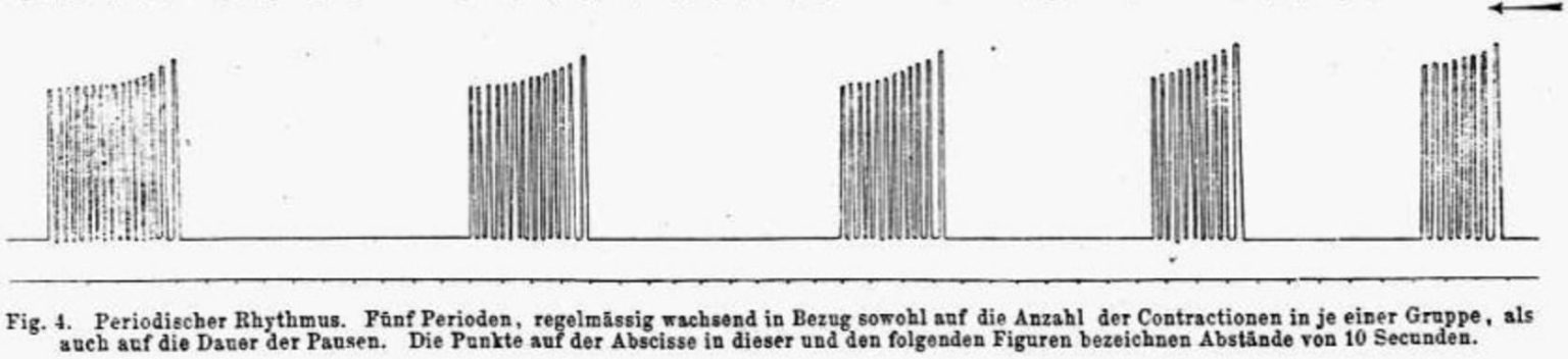 Second-degree Atrioventricular block • LITFL • Medical Eponym Library