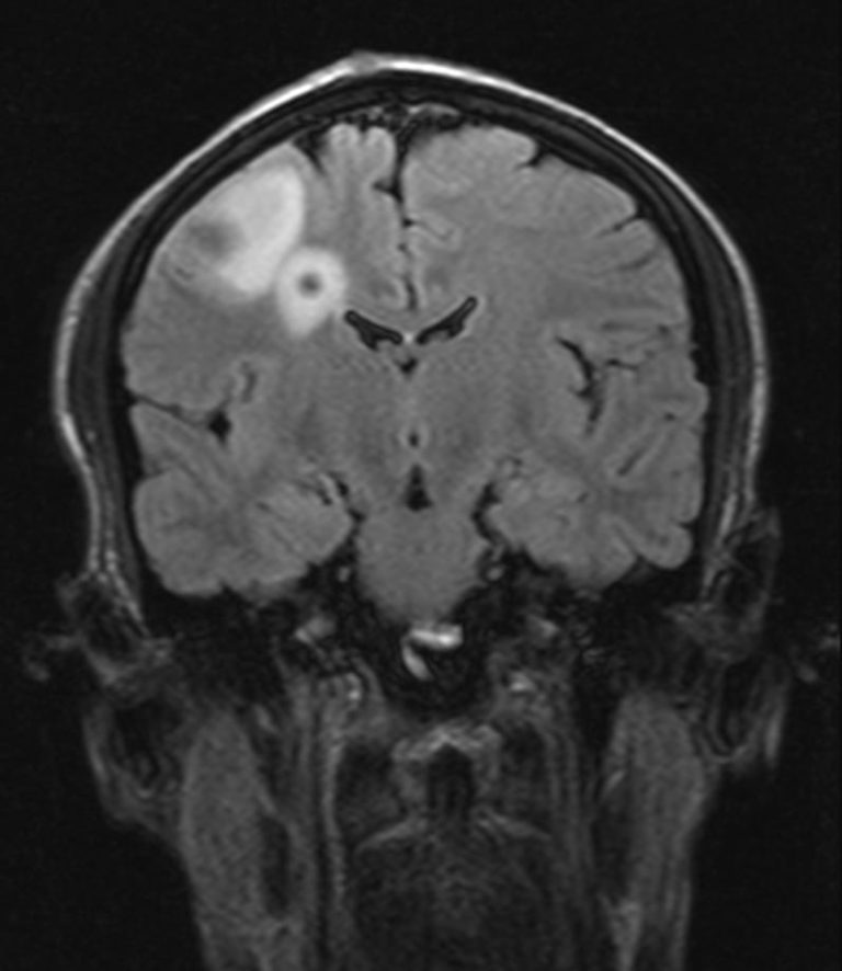 Cannon Balls • LITFL • Oncological Quandary