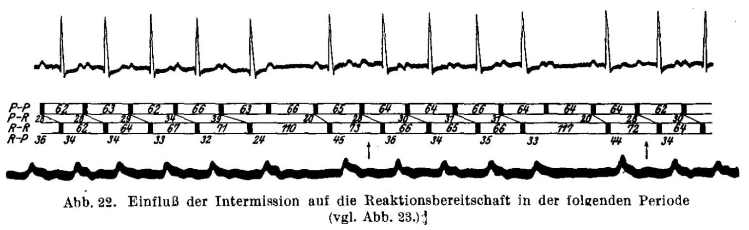 Second-degree Atrioventricular block • LITFL • Eponym Library