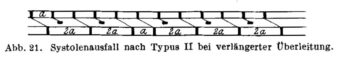 Second-degree Atrioventricular block • LITFL • Eponym Library