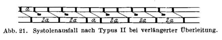Second-degree Atrioventricular block • LITFL • Eponym Library
