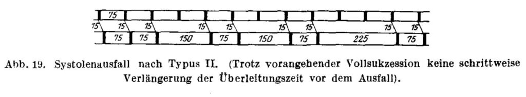 Second-degree Atrioventricular block • LITFL • Eponym Library