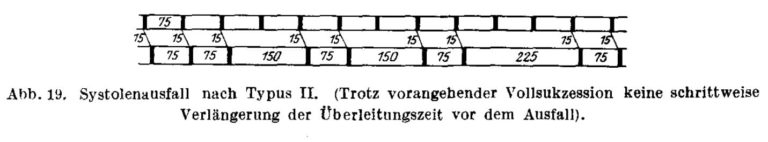 Second-degree Atrioventricular block • LITFL • Eponym Library