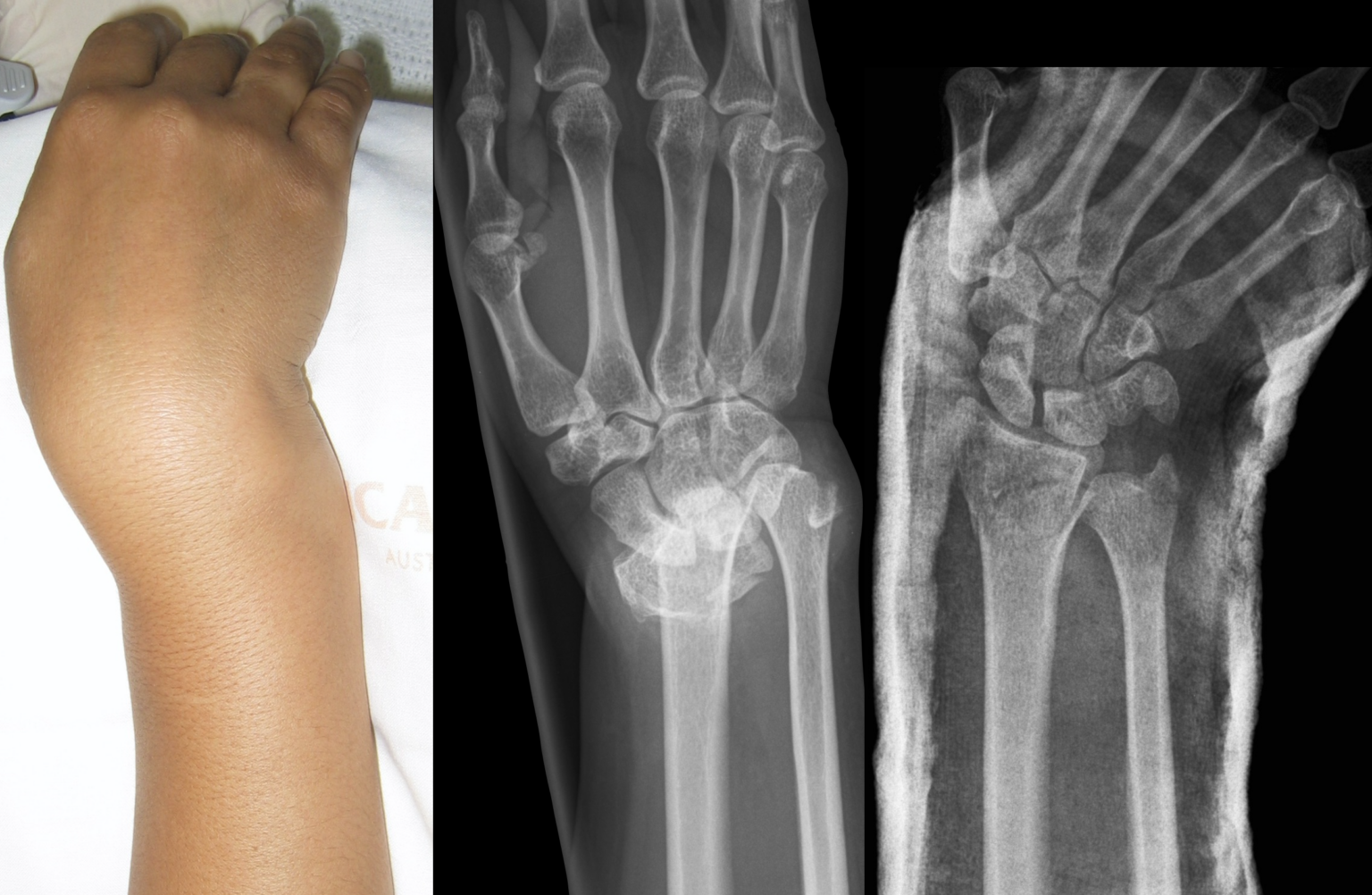 Moore fracture • LITFL Medical Blog • Medical Eponym Library