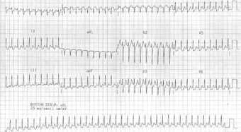 The ST Segment • LITFL • ECG Library Basics