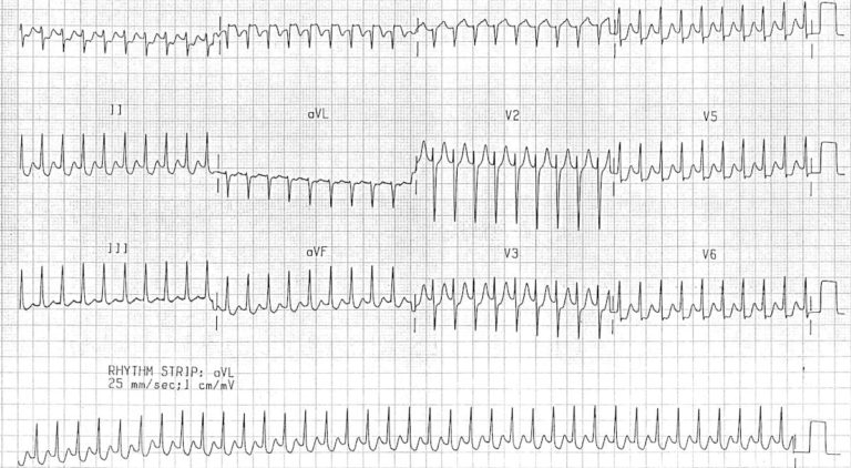 The ST Segment • LITFL • ECG Library Basics