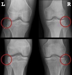 Segond fracture • LITFL Medical Blog • Medical Eponym Library