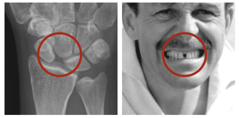 Terry-Thomas Sign • LITFL • Medical Eponym Library