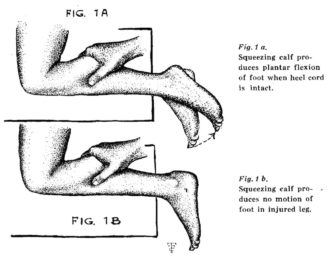 Simmonds-Thompson Test • LITFL • Medical Eponym Library