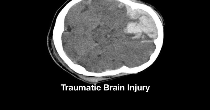 Fine Tuning the Injured Brain • LITFL • Traumatic Brain Injury