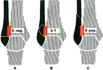 Bernhard Weber • LITFL • Medical Eponym Library