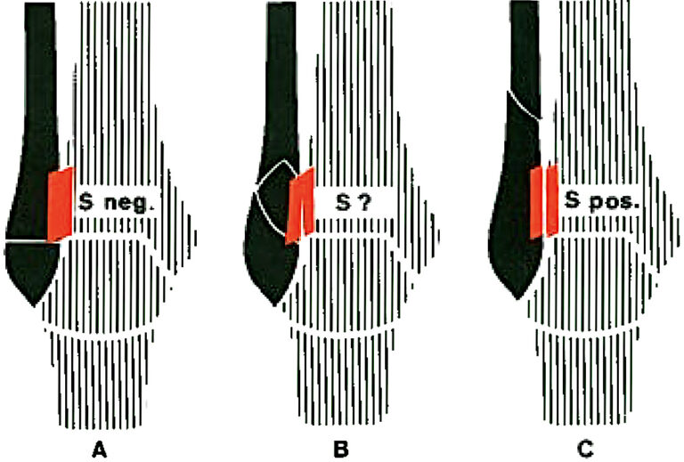 Bernhard Weber • LITFL • Medical Eponym Library