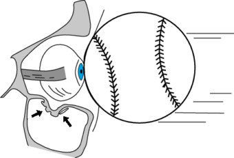 Blown out • LITFL Medical Blog • Ophthalmology Befuddler
