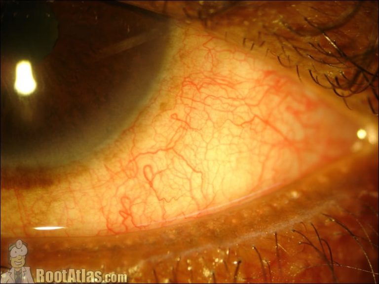 Exasperating Eyelids and the Red Eye • LITFL • Ophthalmology Befuddler