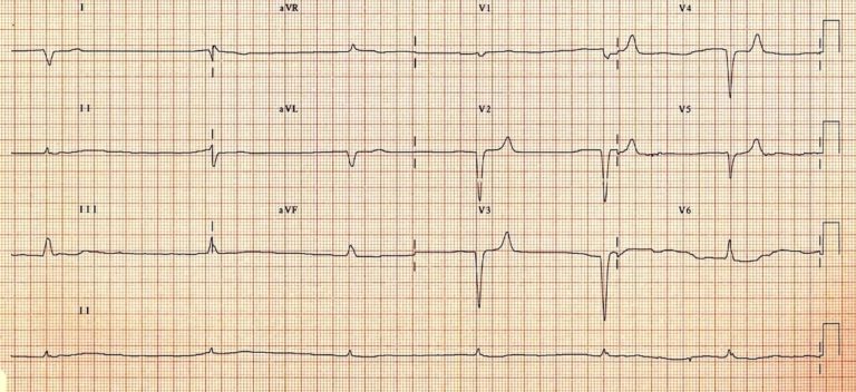 Killer ECG Patterns: Part 1 • LITFL • ECG Library