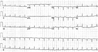 Killer ECG Patterns: Part 1 • LITFL • ECG Library