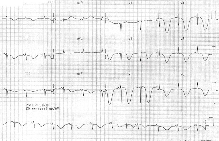 Killer ECG Patterns: Part 1 • LITFL • ECG Library