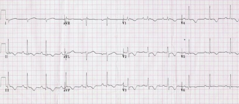 Killer ECG Patterns: Part 1 • LITFL • ECG Library