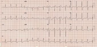 Killer ECG Patterns: Part 1 • LITFL • ECG Library