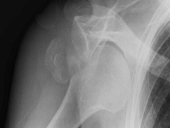 shoulder relocation Archives • LITFL