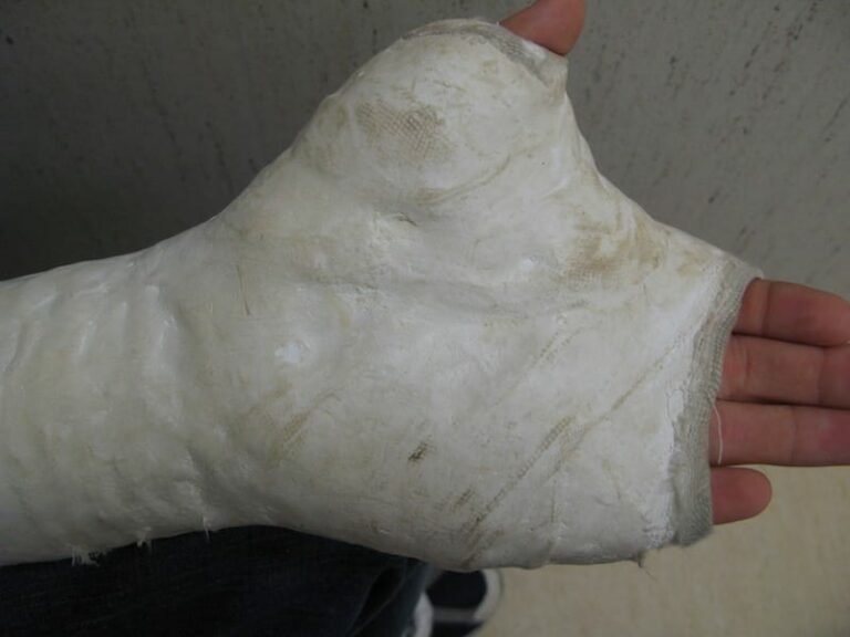 Plaster slab • LITFL • Fracture immbolization and complications