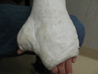 Plaster slab • LITFL • Fracture immbolization and complications