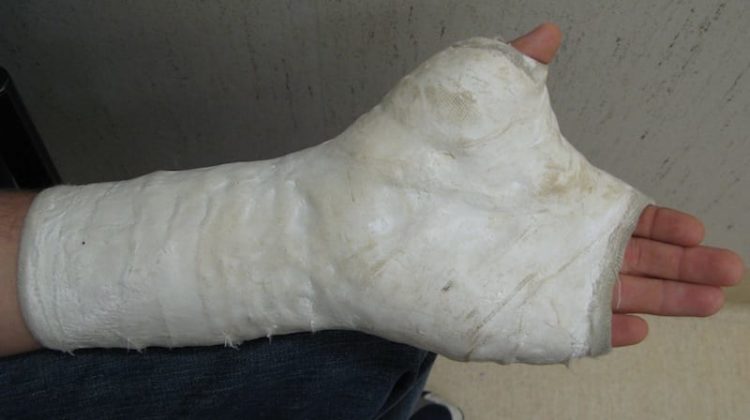 Plaster slab • LITFL • Fracture immbolization and complications