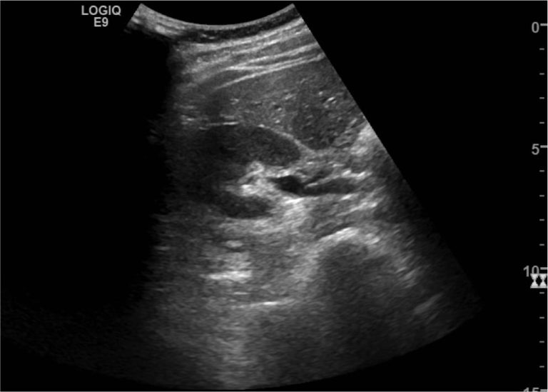 Bladder Stone: Case 2 • LITFL • Ultrasound Clinical Cases