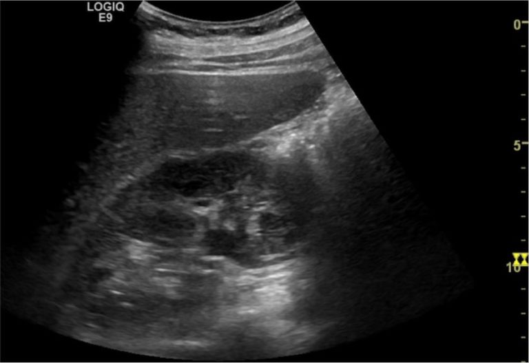 Distal VUJ stone: Case 1 • LITFL • Ultrasound Clinical Cases
